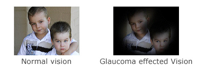 Glaucoma Treatment - Peter Martin – Ophthamology